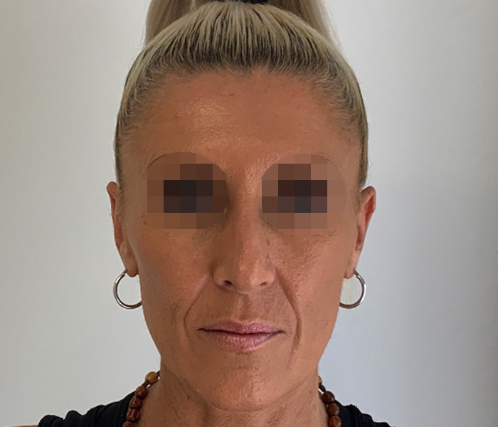 Sculptra Treatments | Auckland | Appearance Matters